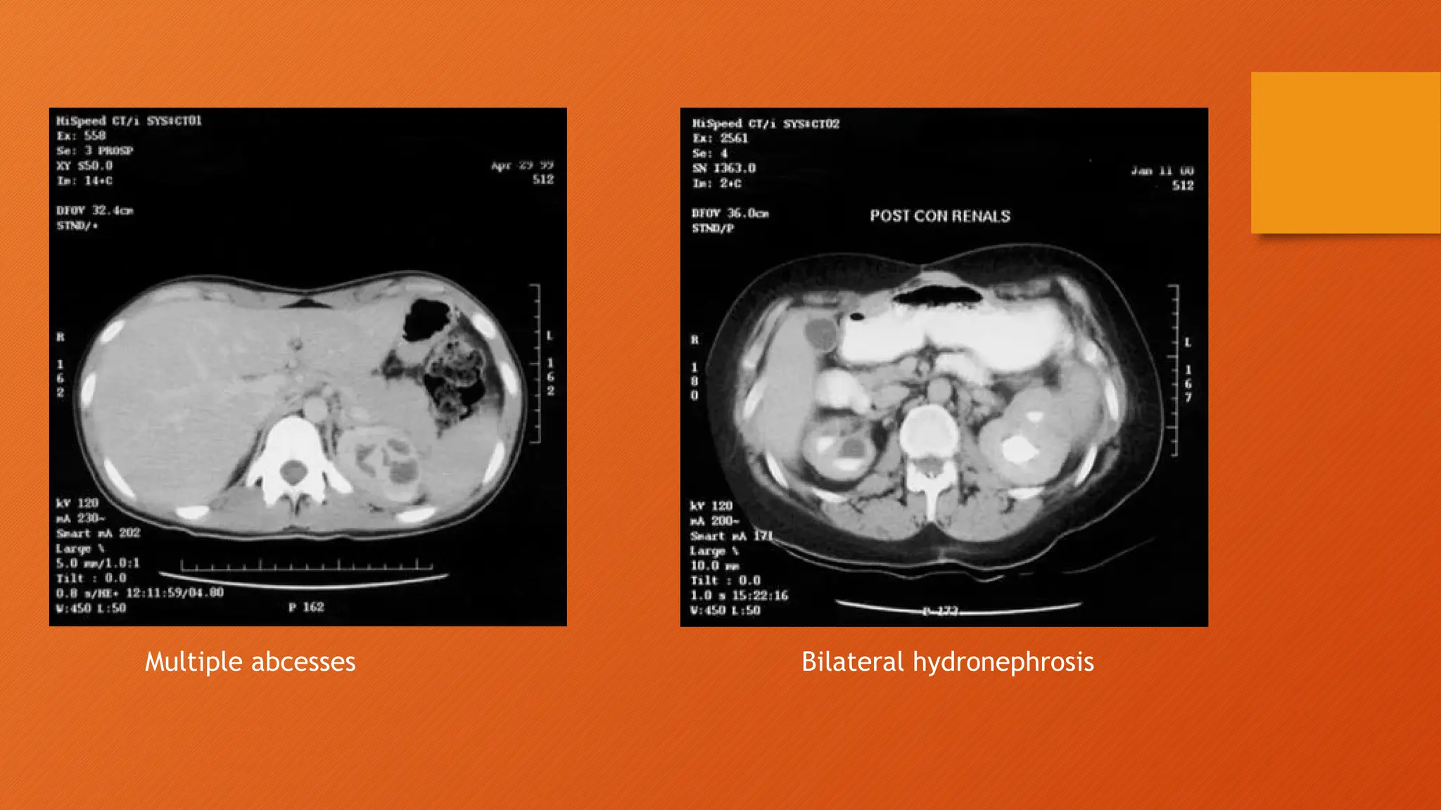 Acute Pyelonephritis an overview approach | PPT