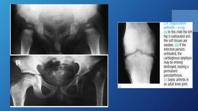 Acute pyogenic arthritis by dr ashutosh | PPTX | Bone and Joint ...