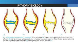 Acute pyogenic arthritis by dr ashutosh | PPTX