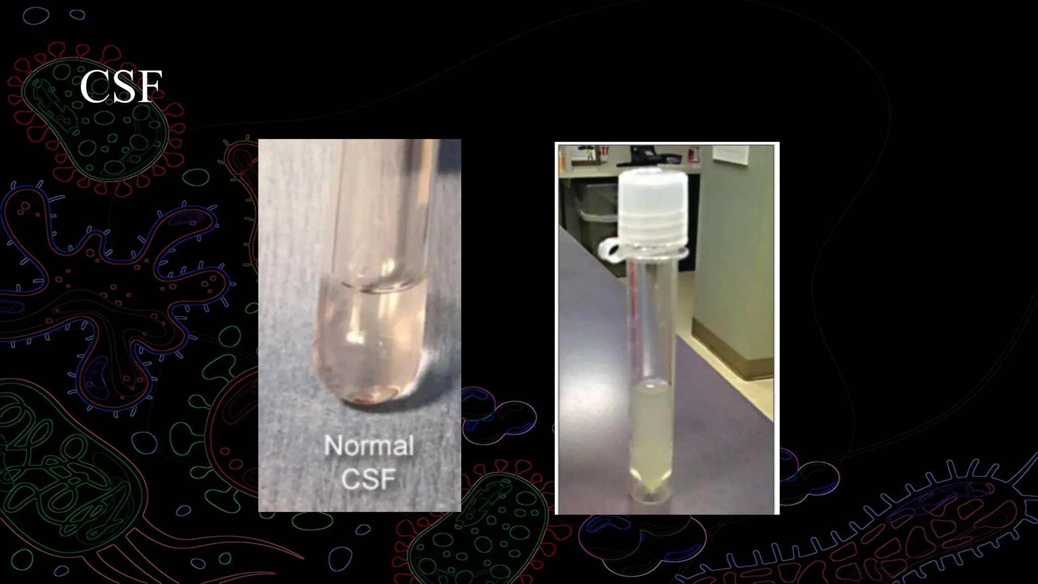 ACUTE PYOGENIC MENINGITIS - Meningitis type.pptx