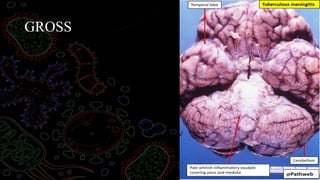 ACUTE PYOGENIC MENINGITIS - Meningitis type.pptx | Brain and Nervous ...