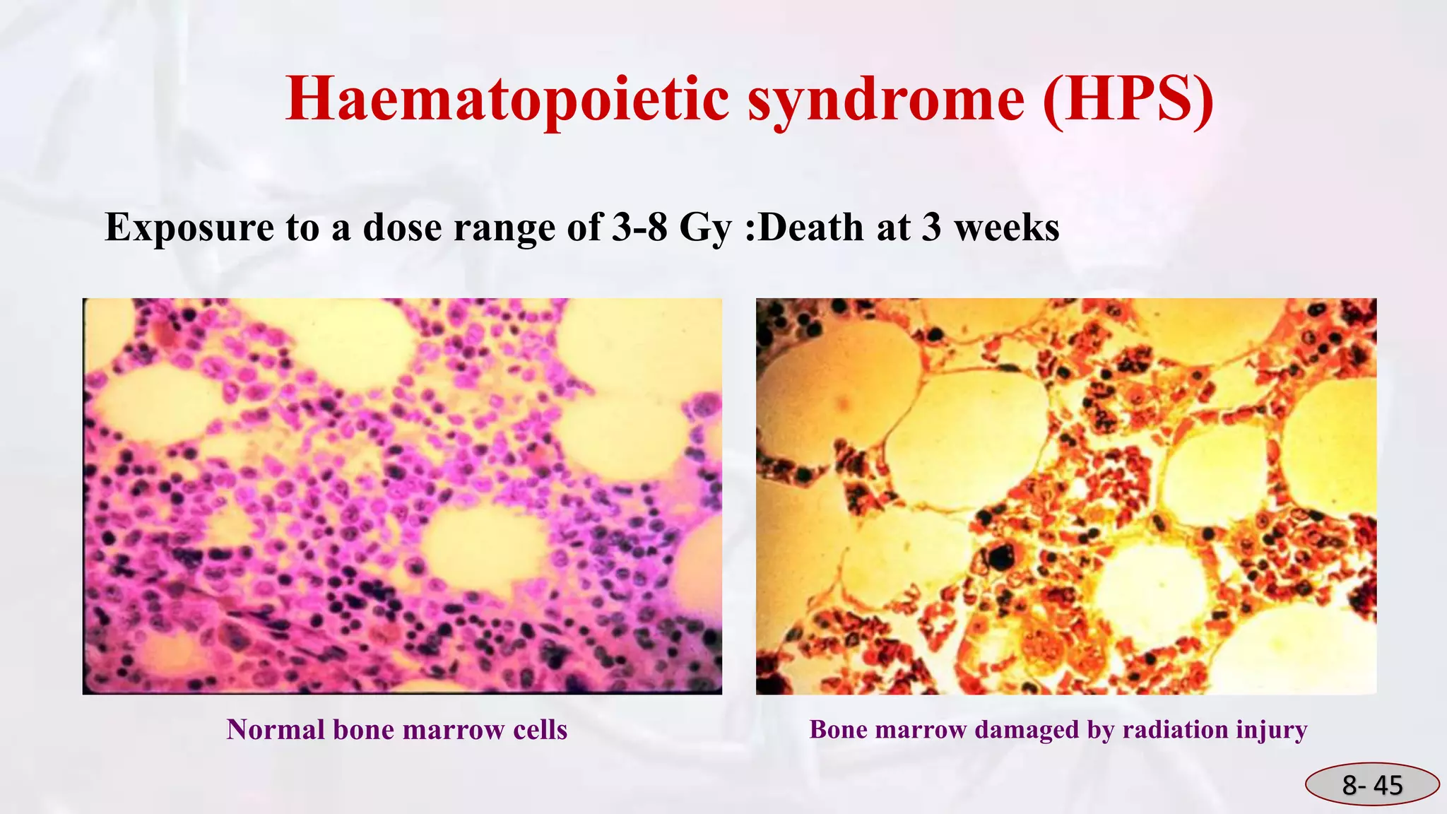 Acute radiation syndrome | PPTX
