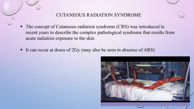 ACUTE RADIATION SYNDROME.pptx | Digestive Disorders | Diseases and ...