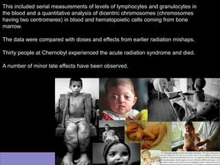 Chernobyl Acute Radiation Syndrome