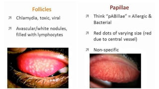 Approach to Acute Red Eye and its DDX.pptx