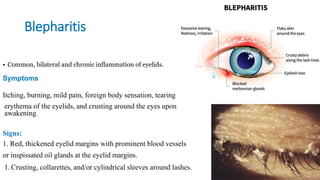 Approach to Acute Red Eye and its DDX.pptx | Eye and Vision Conditions ...
