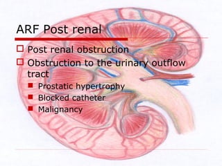 Acute renal failure | PPT