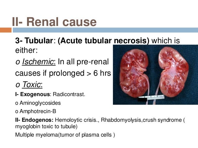 Acute renal failure