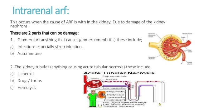 Intrarenal Acute Kidney Failure