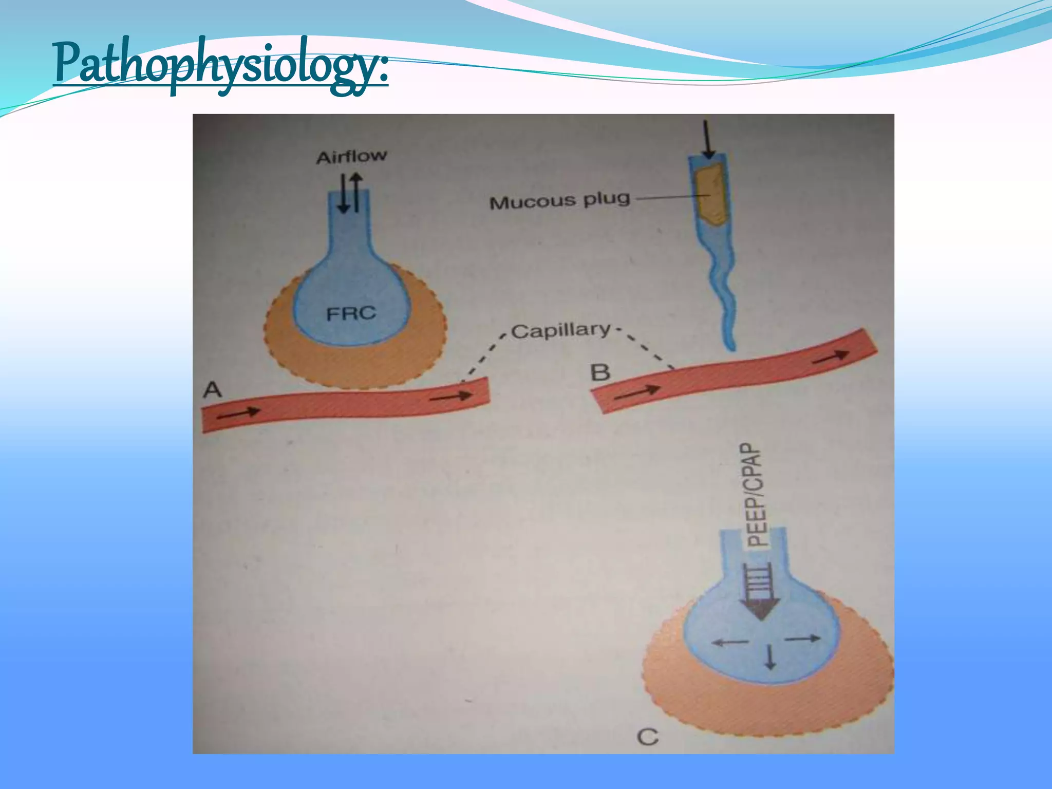 Acute respiratory failure ppt | PPTX