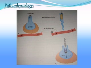 Acute respiratory failure ppt | PPTX