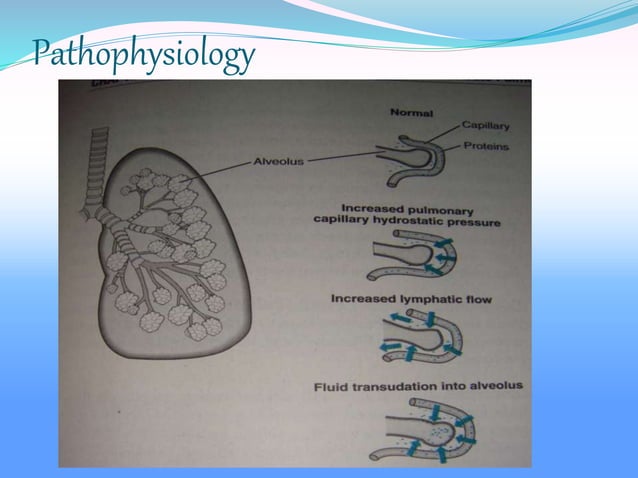 Acute respiratory failure ppt | PPTX