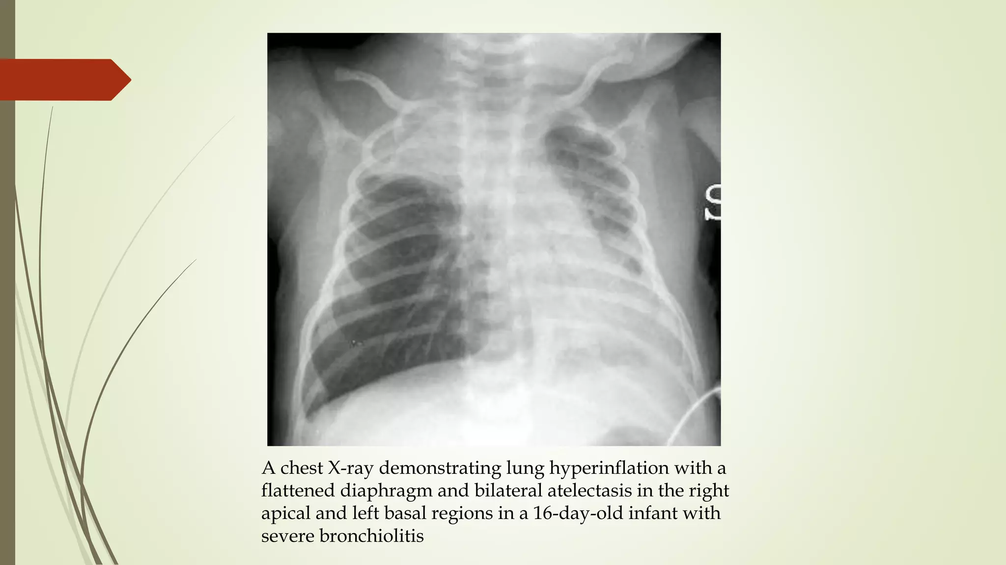 Acute respiratory Infection & IMNCI | PPTX