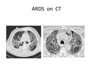 Acute respiratory disease syndrome.ppt