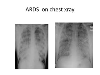 Acute respiratory disease syndrome.ppt