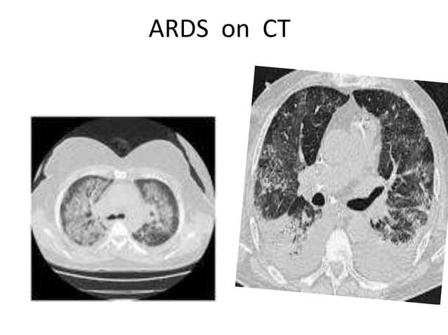 Acute respiratory disease syndrome.ppt