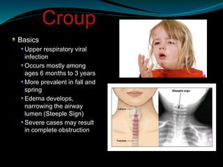 Acute_respiratory_diseses_in_Children___Croup.pptx