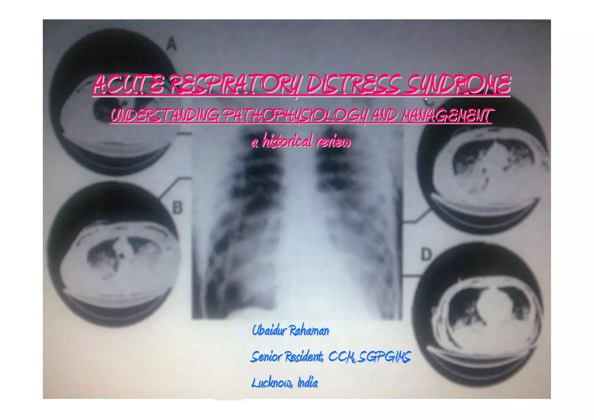 Acute respiratory distress syndrome | PPT