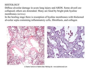 Acute respiratory distress syndrome | PPTX | Lung and Respiratory ...