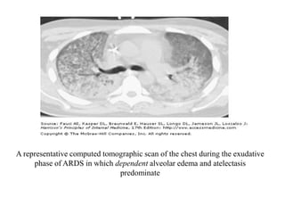 Acute respiratory distress syndrome | PPTX