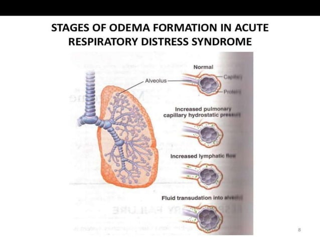 Acute Respiratory Distress Syndrome.pptx