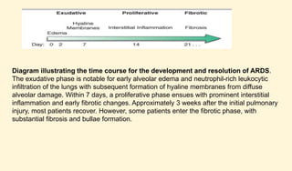 Acute Respiratory Distress Syndrome.pptx