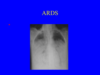 Acute respiratory distress syndrome carre | PPT
