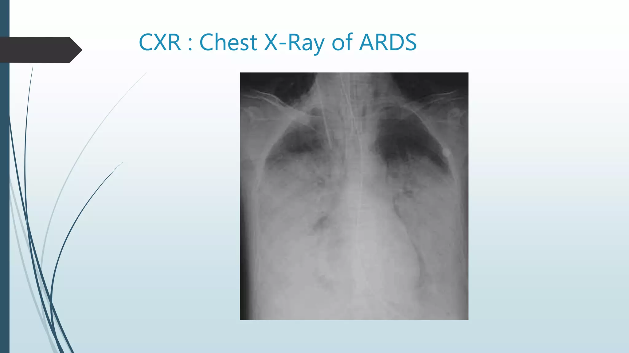 Acute Respiratory Distress Syndrome | PPTX