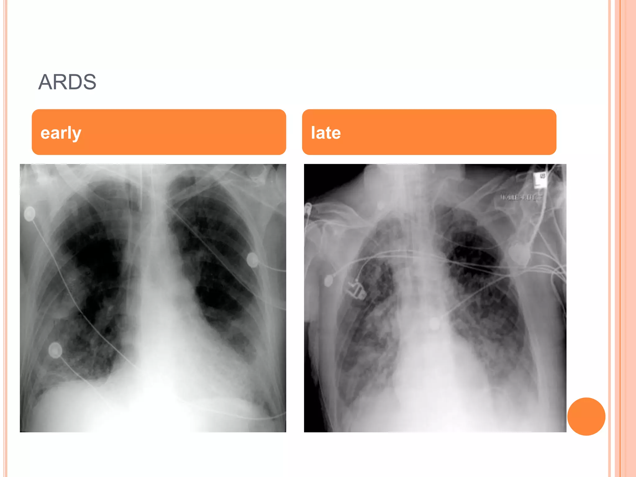 Acute respiratory distress syndrome (ards) | PPTX
