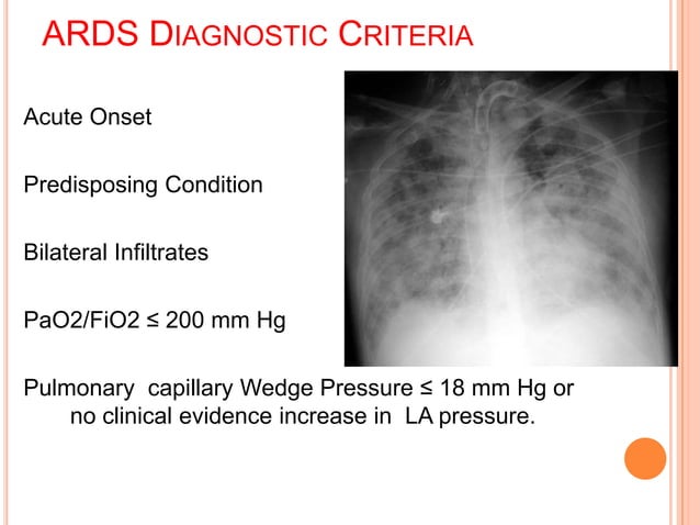 Acute respiratory distress syndrome (ards) | PPTX | Lung and ...