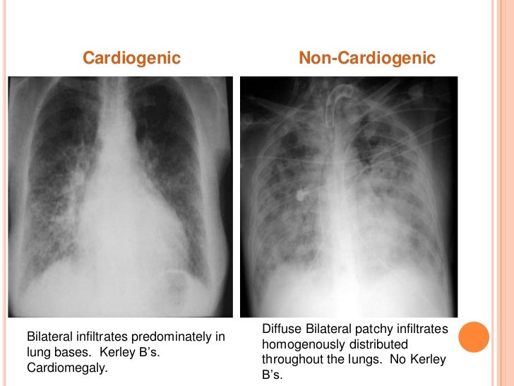 Acute respiratory distress syndrome (ards)
