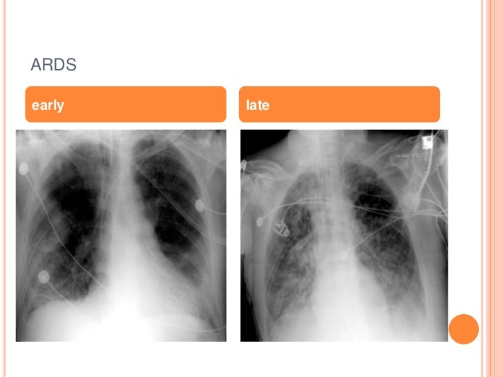 Acute respiratory distress syndrome (ards)