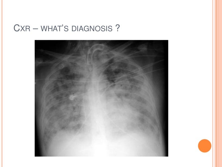 Acute respiratory distress syndrome (ards)