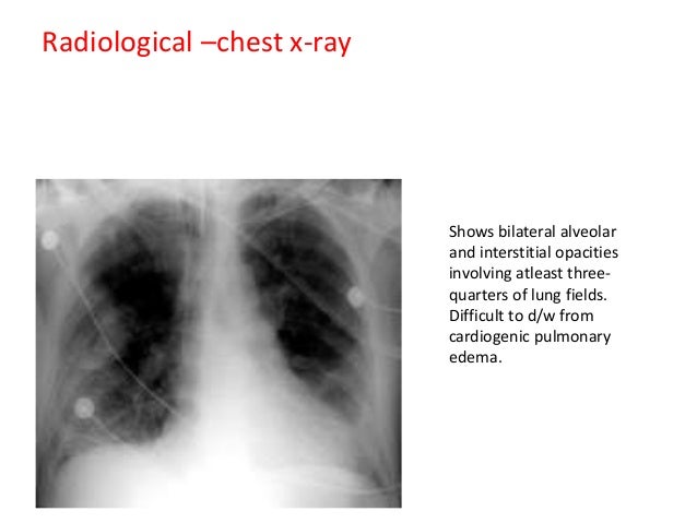 Acute Respiratory Distress Syndrome ARDS