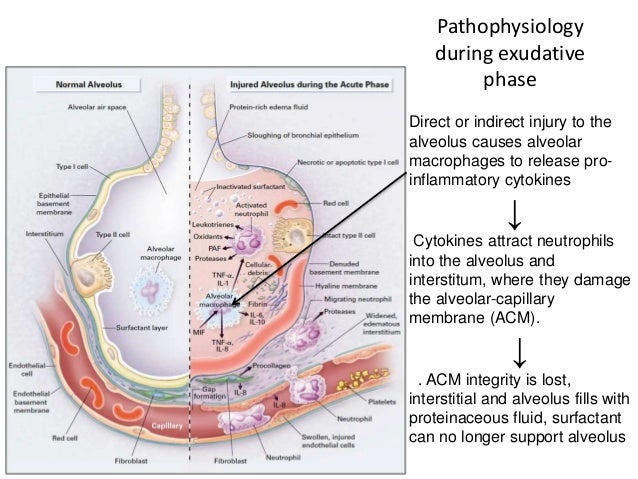 Acute Respiratory Distress Syndrome ARDS
