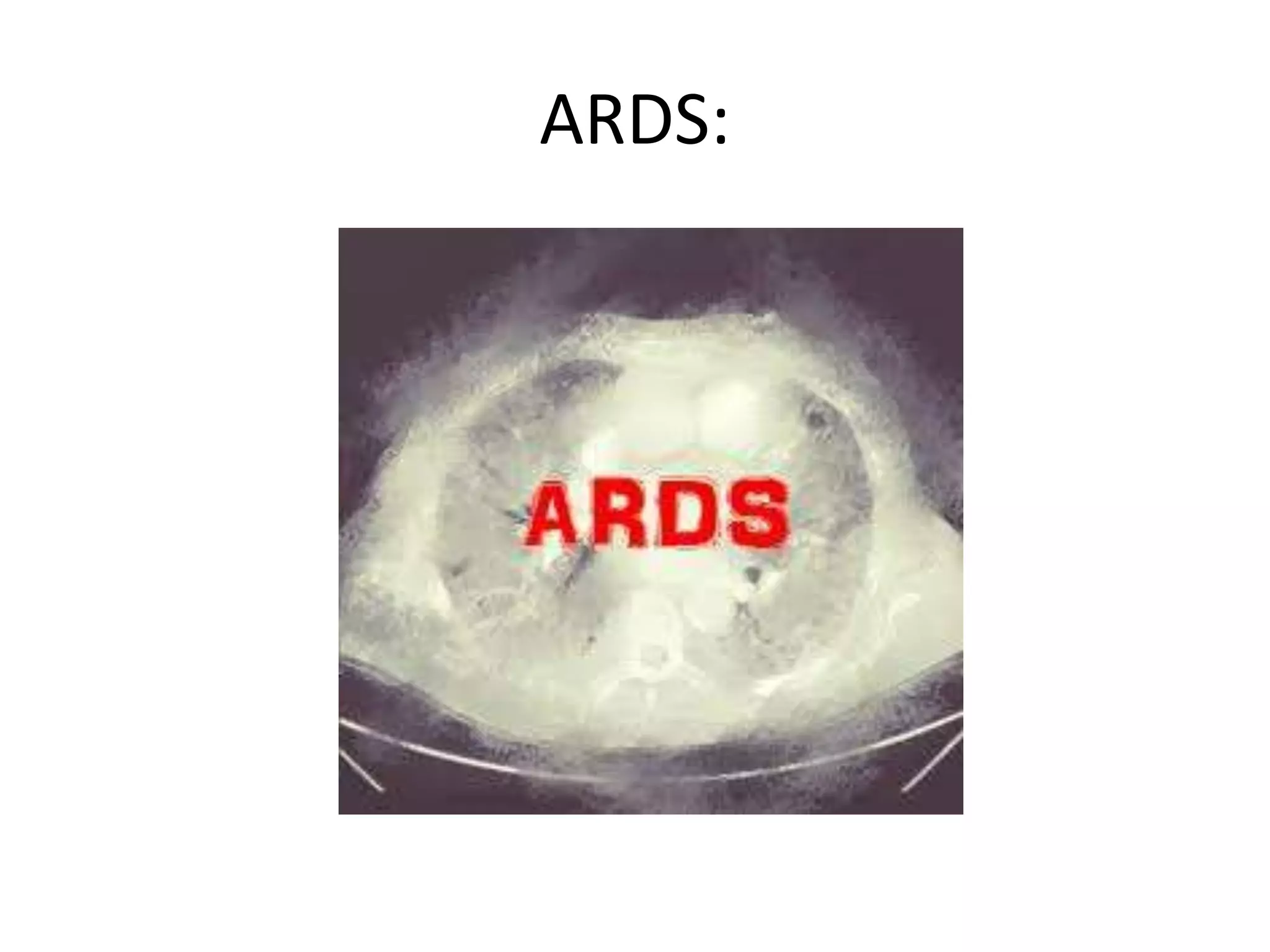 Acute respiratory distress syndrome(ards) | PPTX
