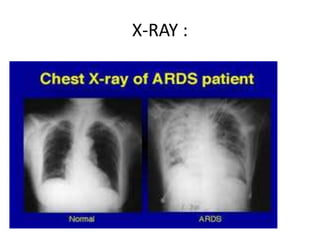 Acute respiratory distress syndrome(ards) | PPTX