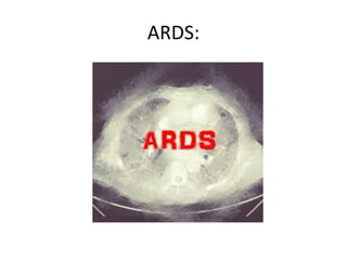 Acute respiratory distress syndrome(ards) | PPTX