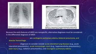 Acute respiratory distress syndrome (ARDS).pptx