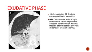 Acute respiratory distress syndrome (ARDS) Dr. NAG.pptx