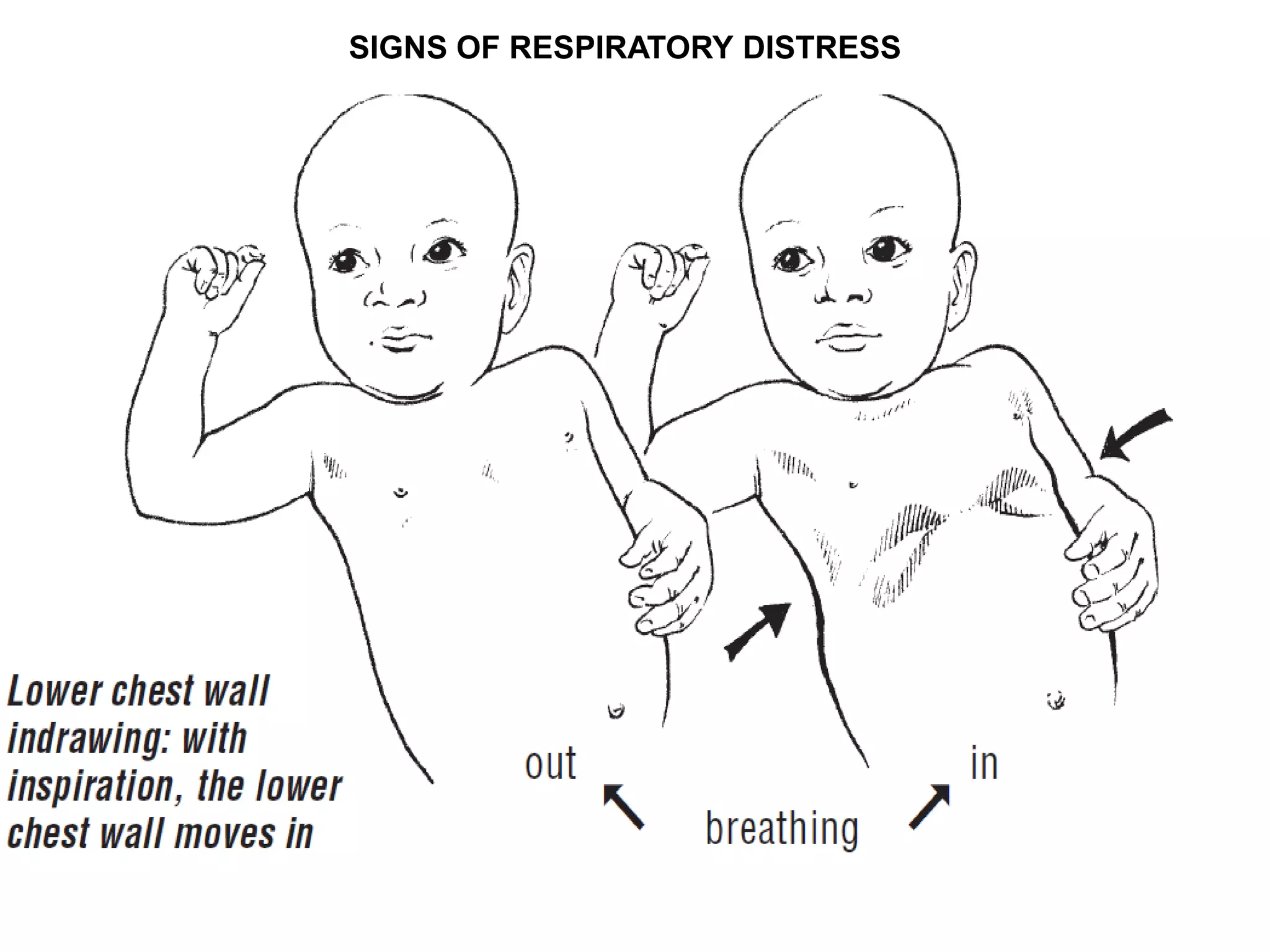 ACUTE RESPIRATORY INFECTIONS/PNEUMONIA | PPSX