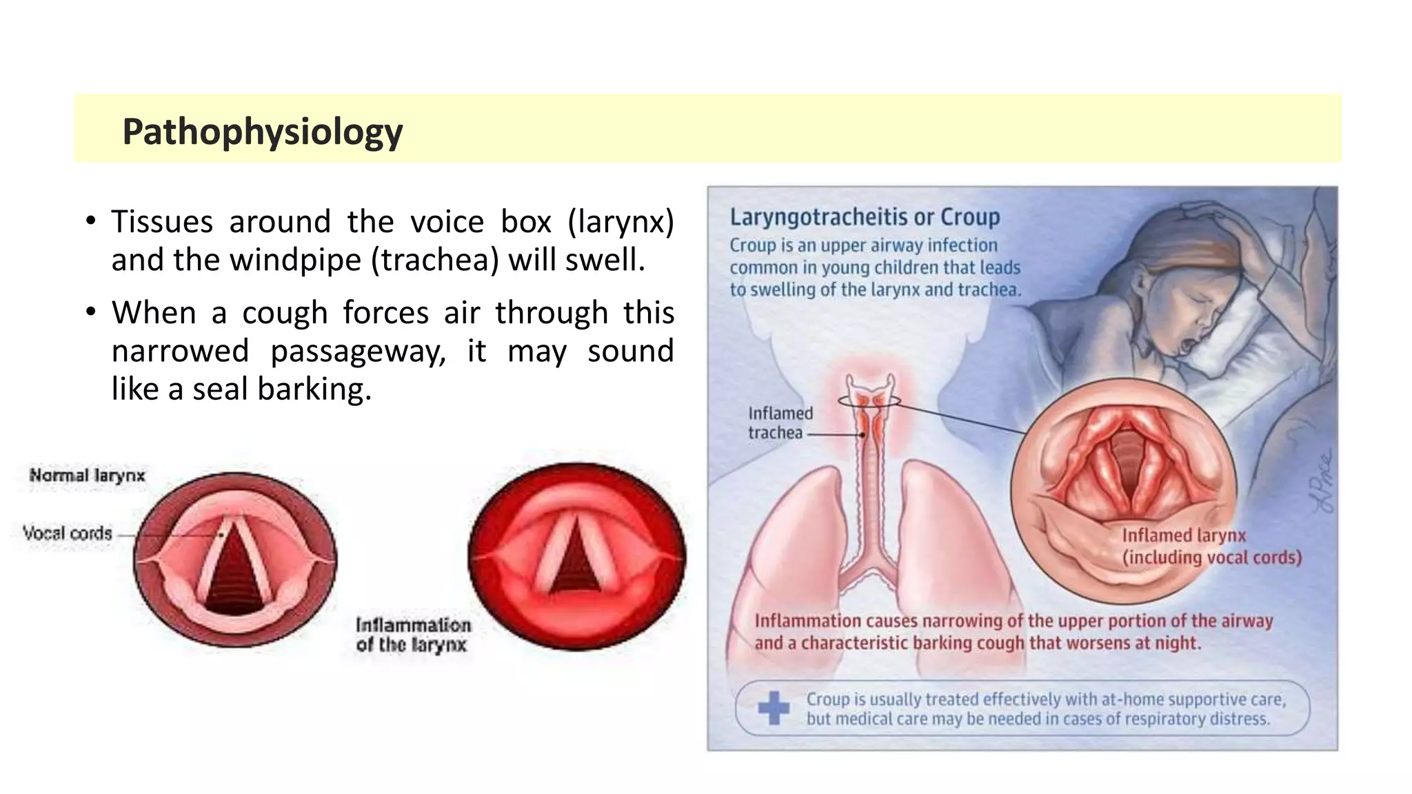 Acute respiratory infection | PPT