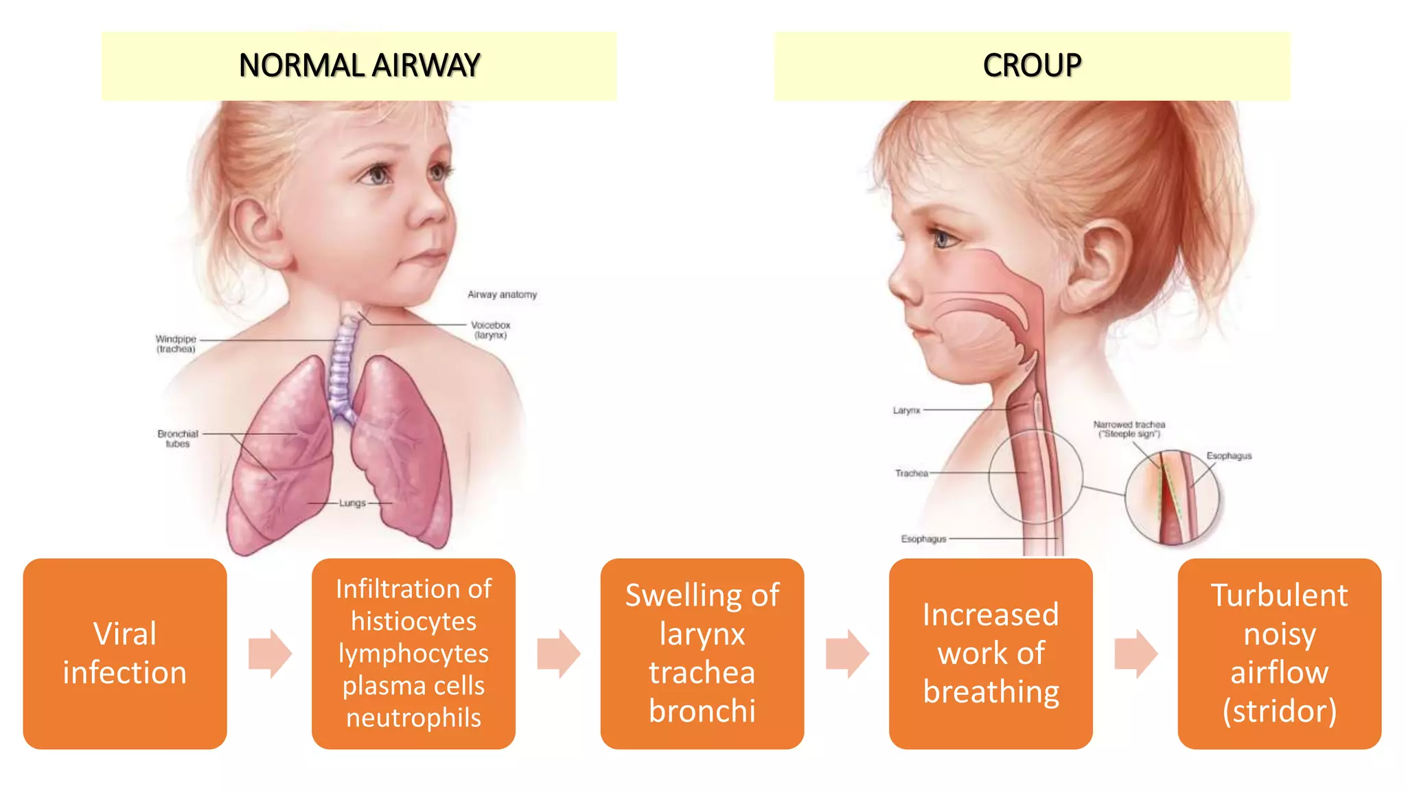 Acute respiratory infection | PPT