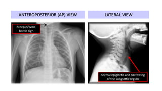 Acute respiratory infection | PPT