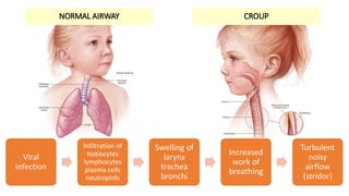 Acute respiratory infection | PPT