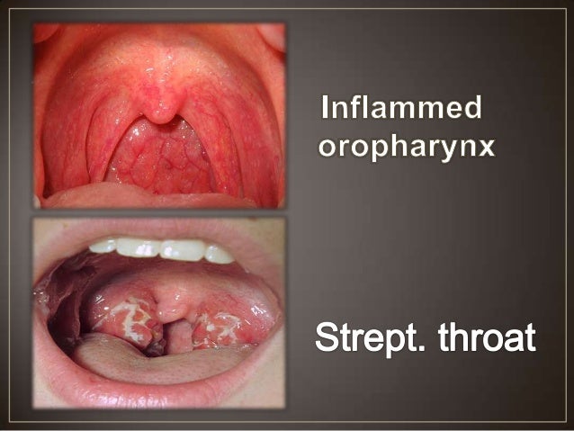 Acute respiratory infections in children