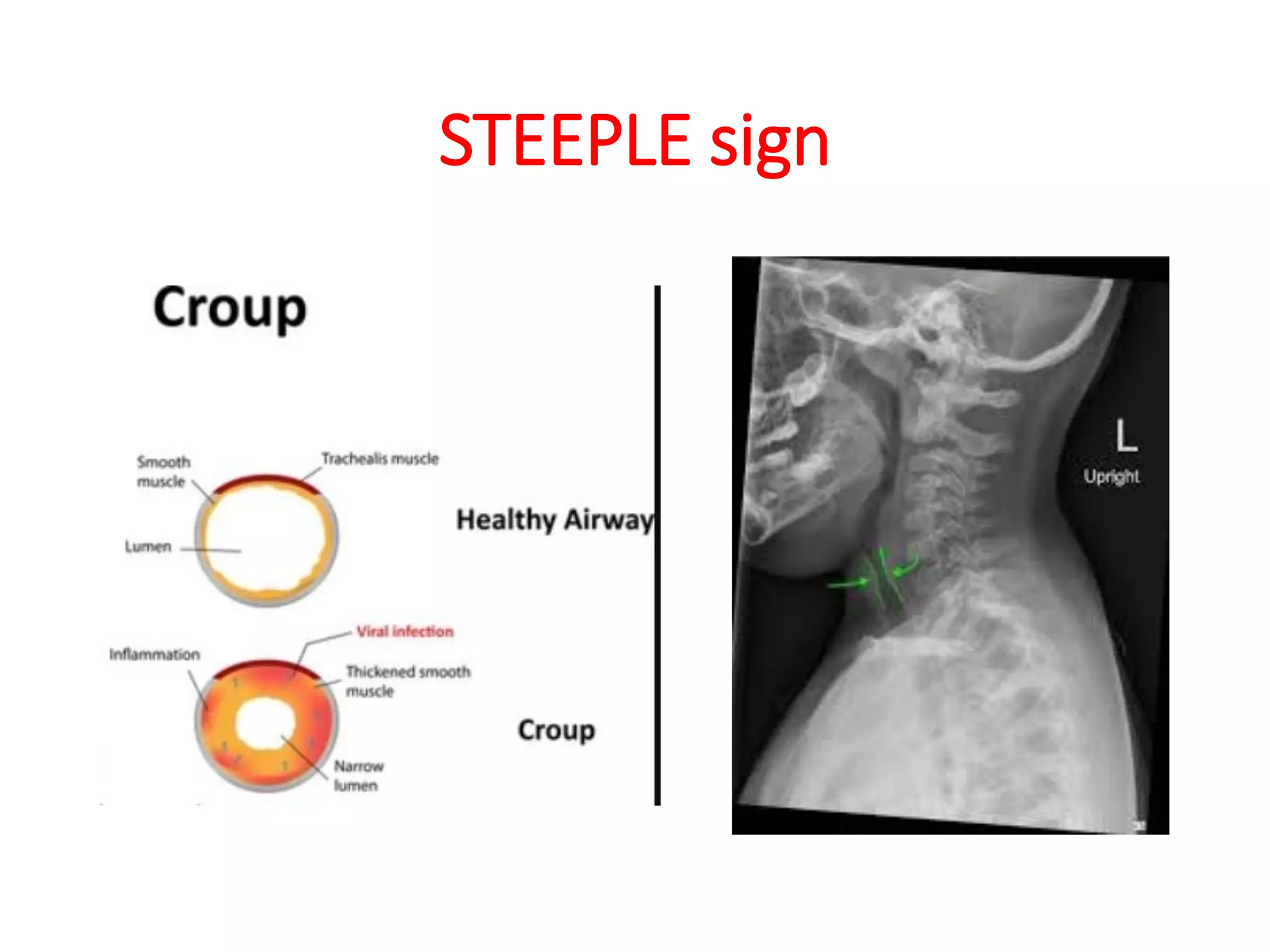 Acute respiratory infections 2021 | PDF