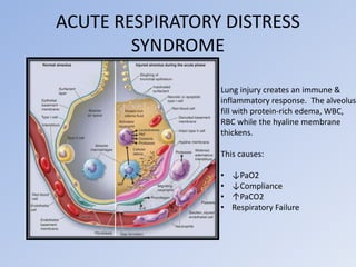 Acute Respirtaory Distress Syndrome | PPTX