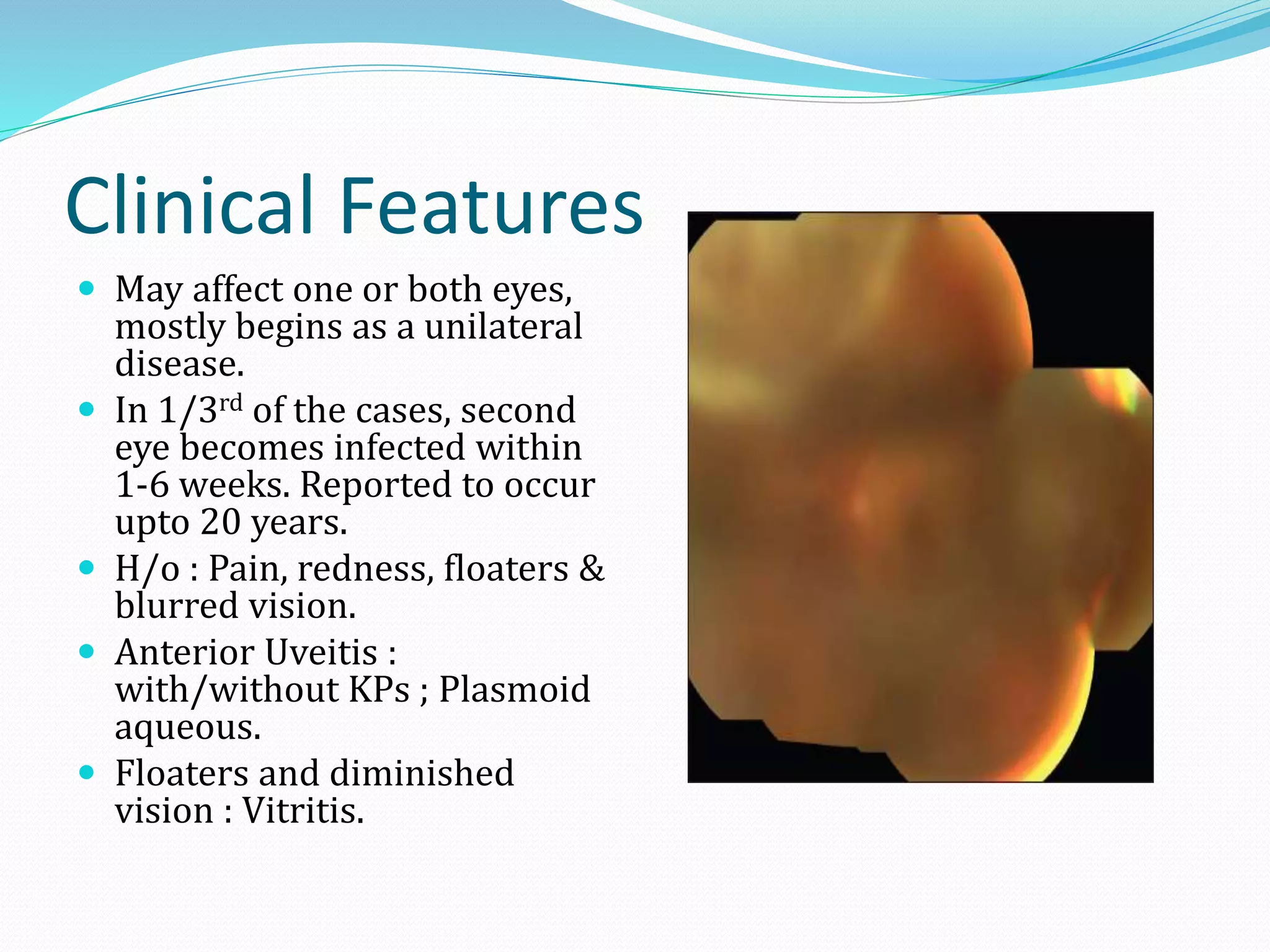 Acute retinal necrosis | PPTX