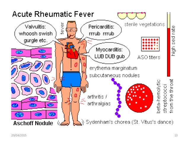 Acute rheumatic fever